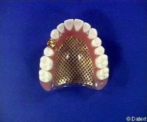 Die Vollprothese | Krämer Zahntechnik