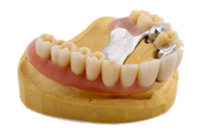 Herausnehmbarer Zahnersatz | Krämer Zahntechnik