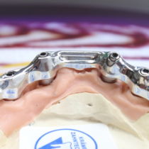 Die Vollprothese | Krämer Zahntechnik