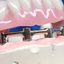 Die Vollprothese | Krämer Zahntechnik