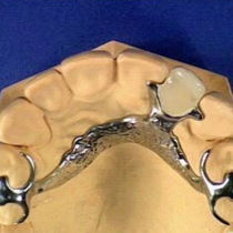 Die Modellgussprothese | Krämer Zahntechnik